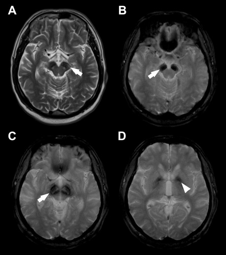 Expanding the clinical phenotype of BPAN: A case report - MDS Abstracts